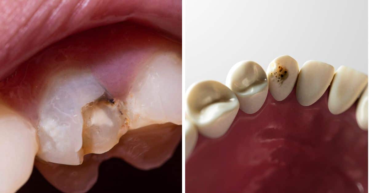 Preventing and Healing Tooth Decay | Paleo Leap