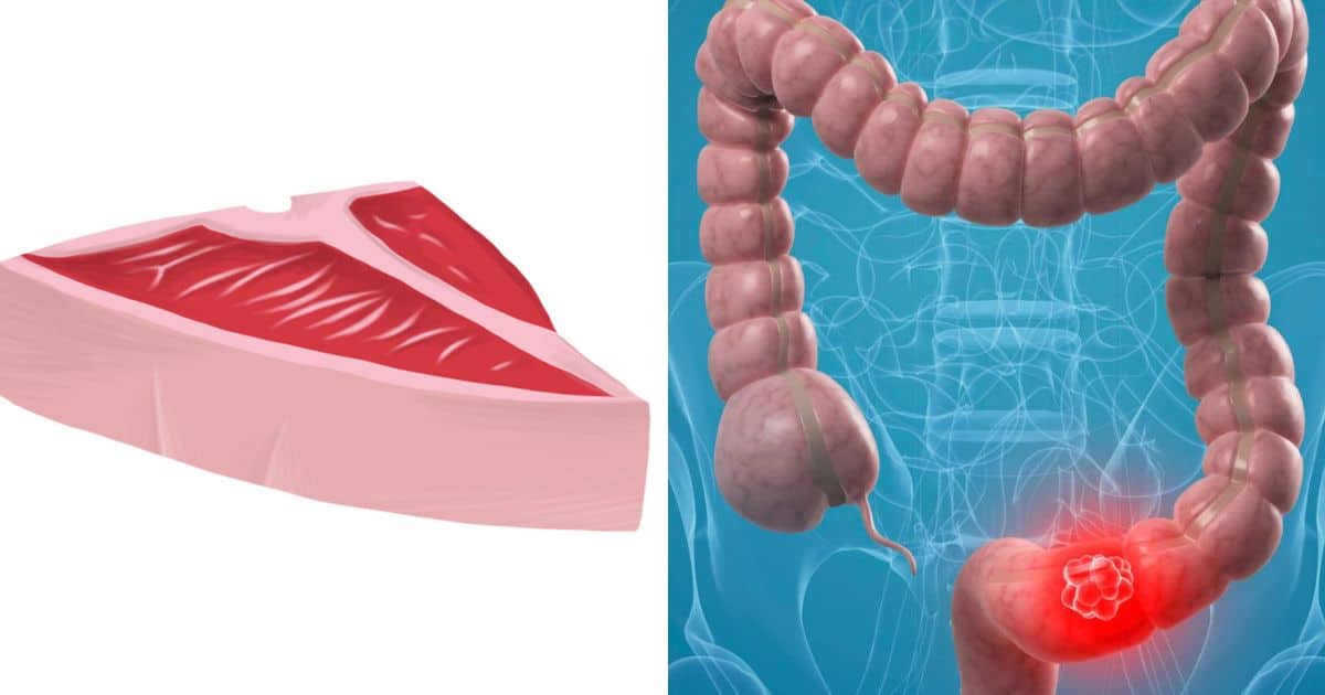 A Closer Look at Red Meat and Colon Cancer | Paleo Leap