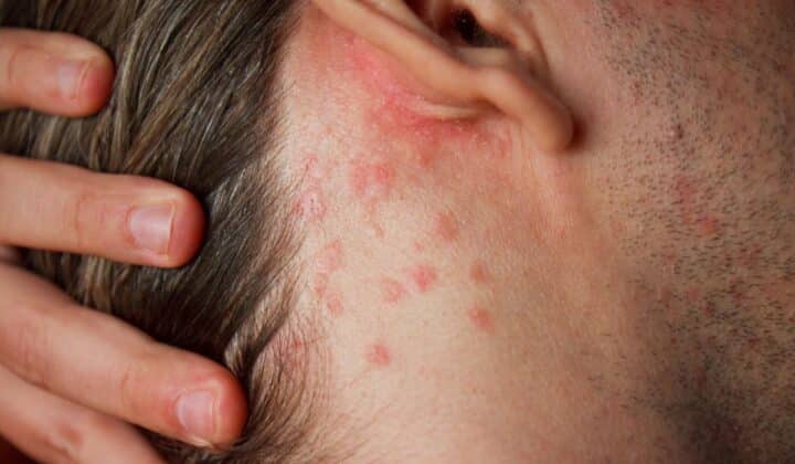 5 Things to Know About Keto Rash (Prurigo Pigmentosa) | Paleo Leap